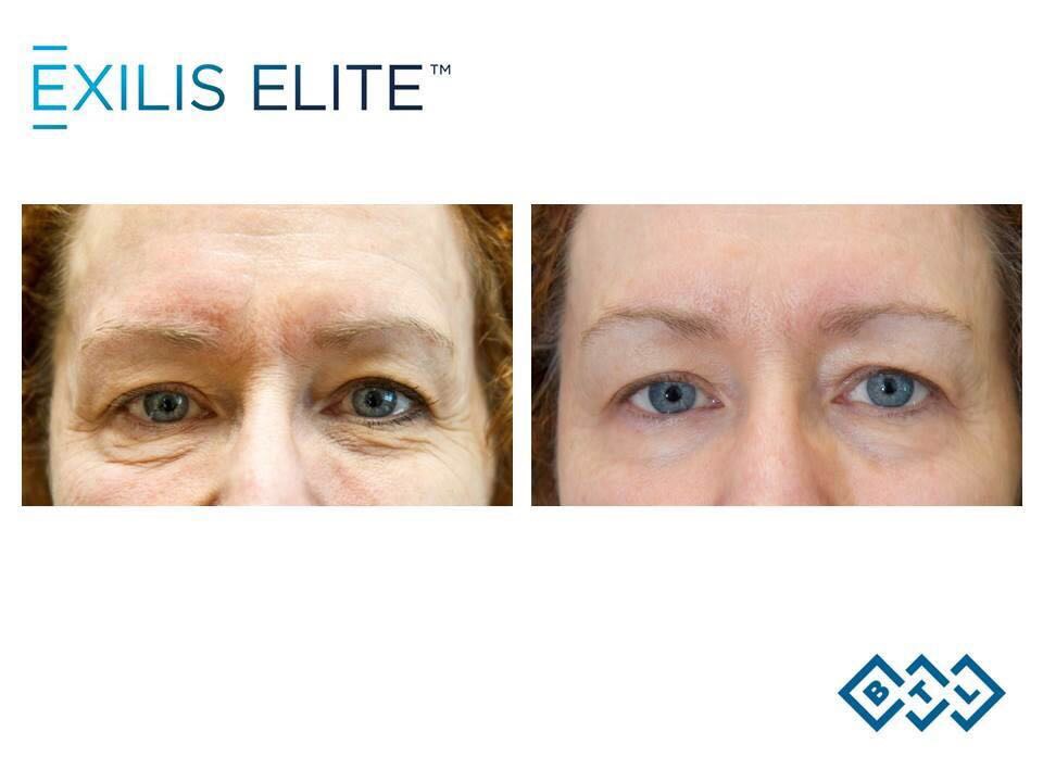 BTL Exilis Elite Skin Tightening and Fat/Cellulite Reduction